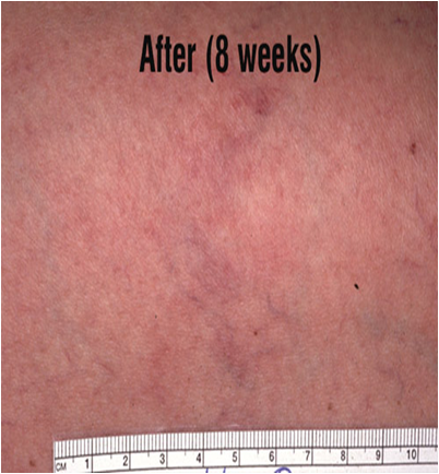 Ευρυαγγείες Προσώπου - Neotis - Neotis