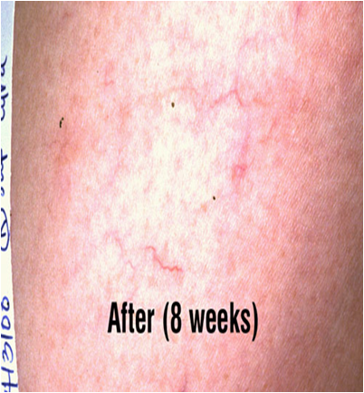 Venosclerosis / Σκληροθεραπεία - Neotis - Neotis